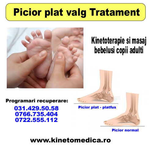 Picior plat valg tratament | Centre recuperare medicala Bucuresti ...